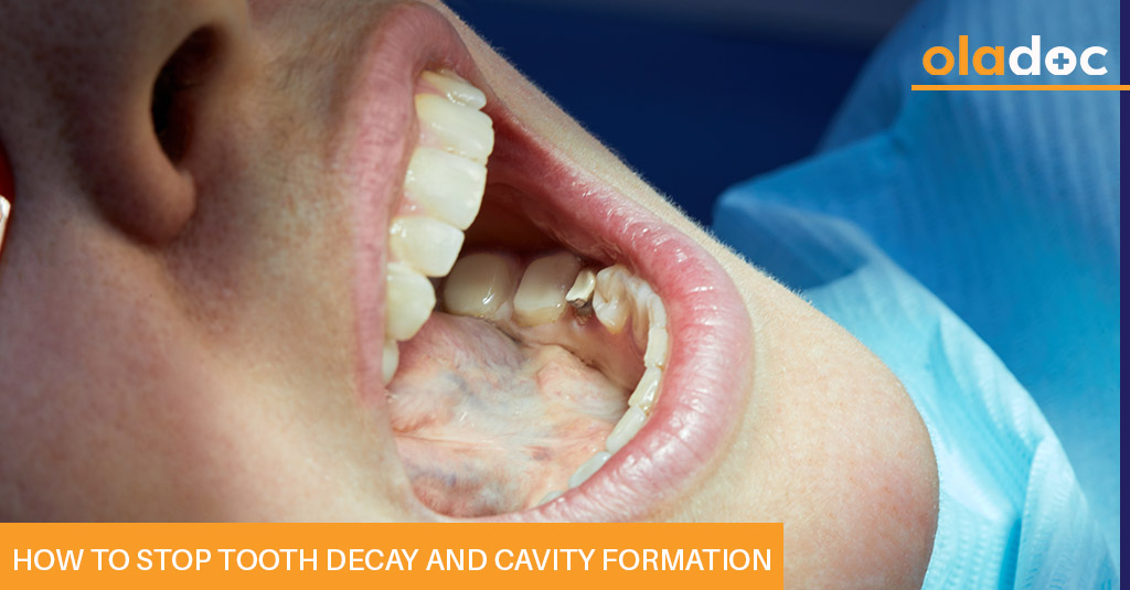 How to Stop Tooth Decay and Cavity Formation | Teeth and Gums | oladoc.com