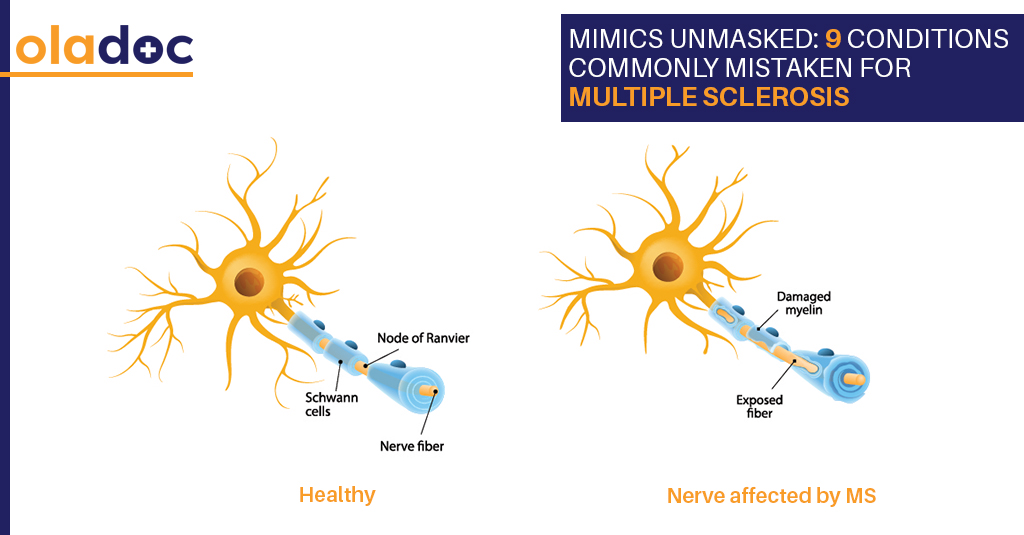 Mimics Unmasked: 9 Conditions Commonly Mistaken for Multiple Sclerosis ...